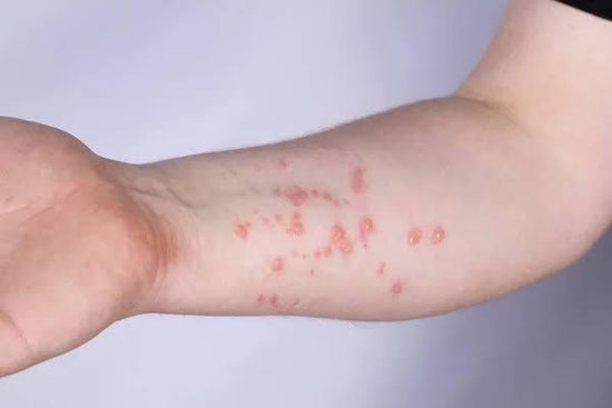 Wat is waterpokkies? – 4aKid